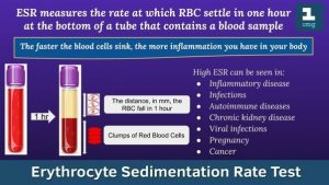 ESR Blood Tests - Dublin Health Screening